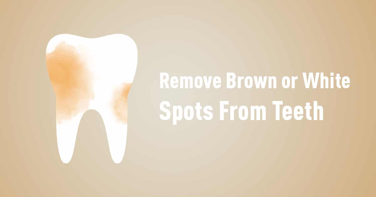 Teeth Whitening: ICON Infiltration Therapy | The Dental Studio, Singapore