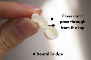 How To Care For Your Dental Bridge - Dental Studio