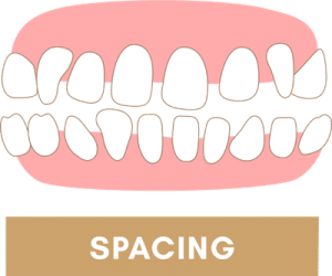 How To Determine If You Need Braces For Teeth Straightening | The ...